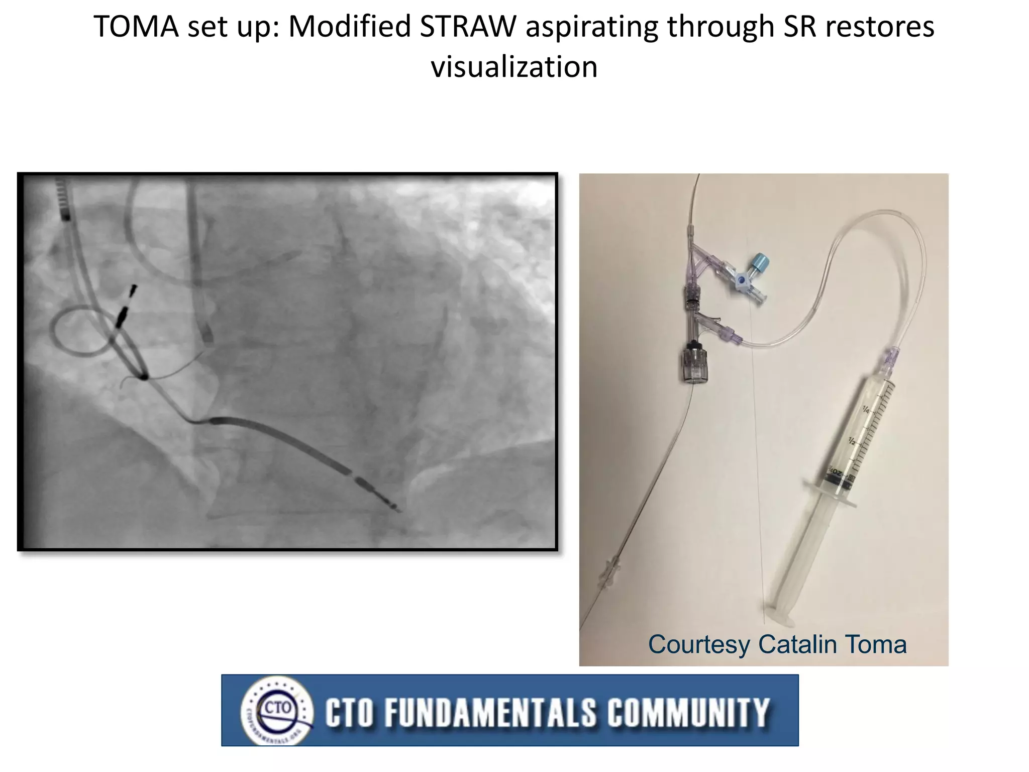 Antegrade dissection and haematoma | PPT