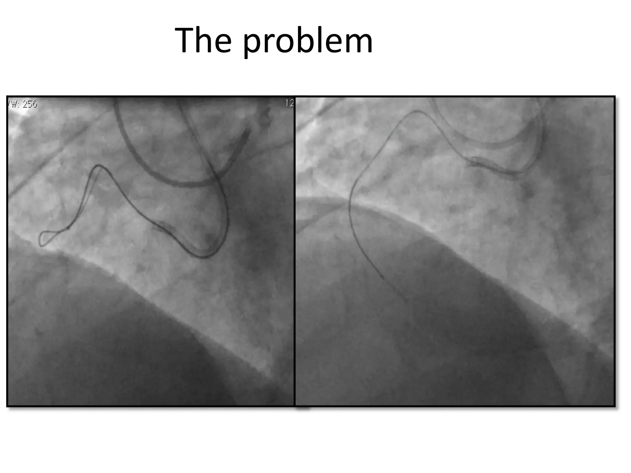 Antegrade dissection and haematoma | PPT