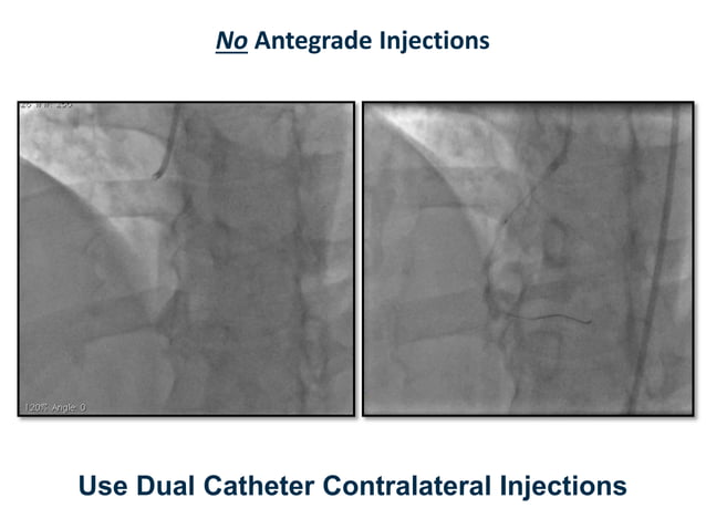 Antegrade dissection and haematoma | PPT