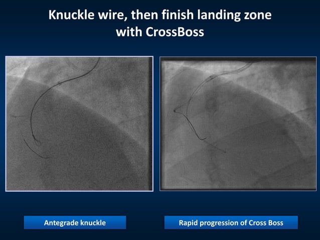Antegrade dissection and haematoma | PPT