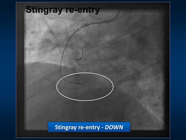 Antegrade dissection and haematoma | PPT
