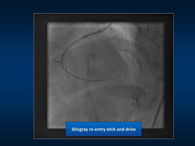 Antegrade dissection and haematoma | PPT