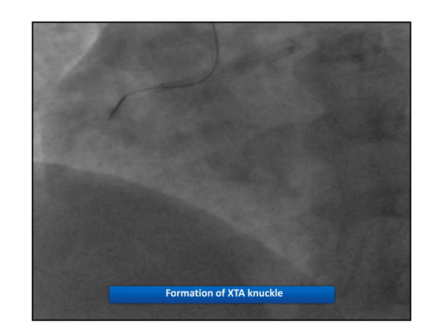 Antegrade dissection and haematoma | PPT