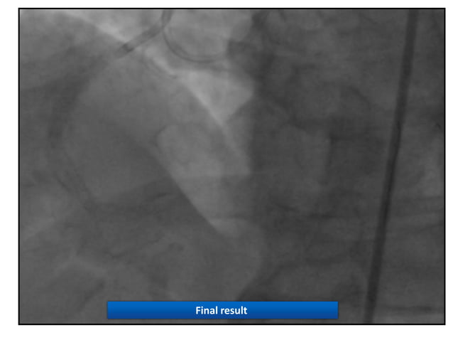 Antegrade dissection and haematoma | PPT