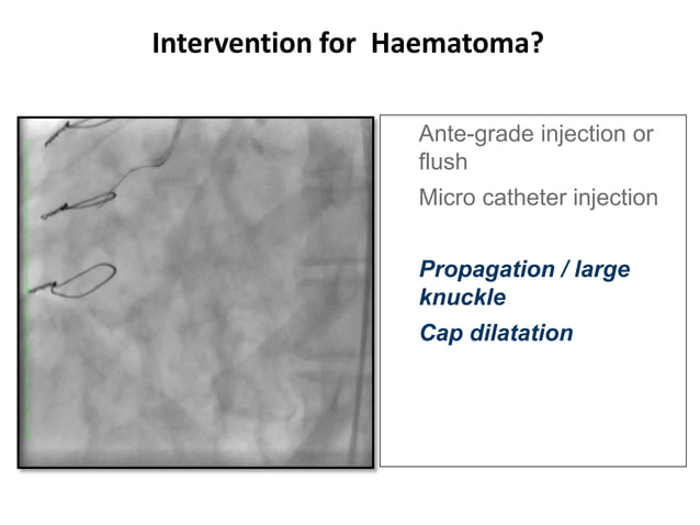 Antegrade dissection and haematoma | PPT