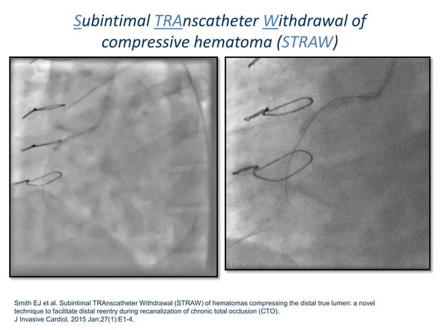 Antegrade dissection and haematoma | PPT