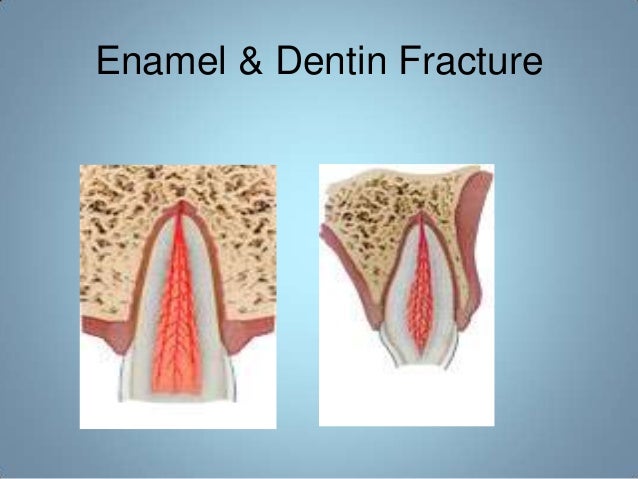 Ellis class i & ii fracture