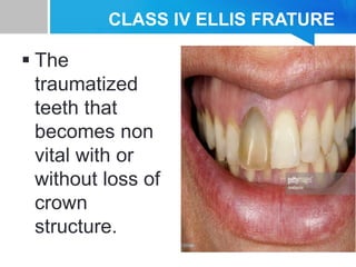 Management of Ellis Class IV Fracture | PPTX