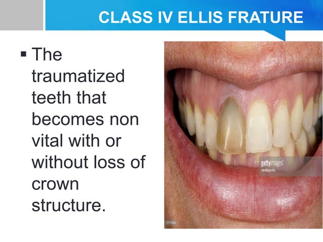Management of Ellis Class IV Fracture | PPTX | Dental Health | Diseases ...