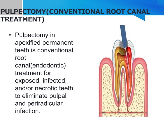 Management of Ellis Class IV Fracture | PPTX | Dental Health | Diseases ...