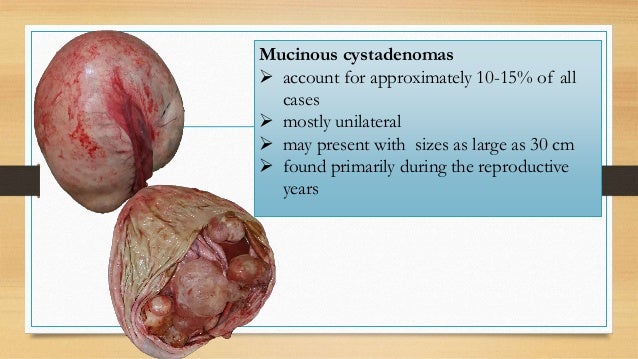 appendectomy in mucinous cyst adenoma
