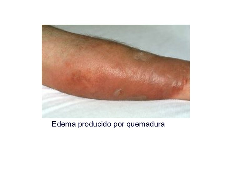 El paciente con edema