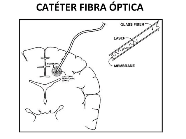 El paciente neuroquirurgico. manejo de la pic y sistema becker | PPT