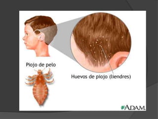 El piojo | PPTX