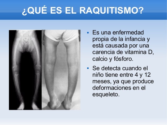 EL RAQUITISMO 3B. LAURA GUTIERREZ