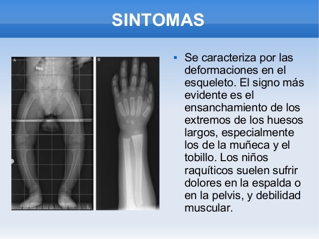 EL RAQUITISMO 3B. LAURA GUTIERREZ