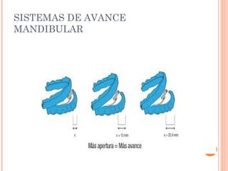 El síndrome de apnea hipopnea del sueño | PPT