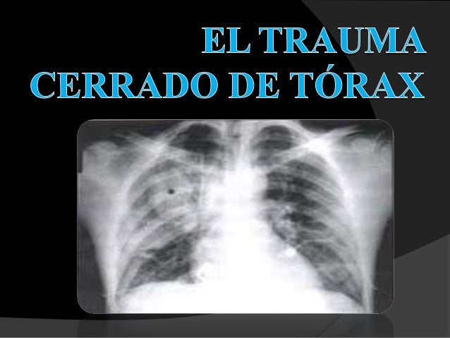 Trauma cerrado de tórax