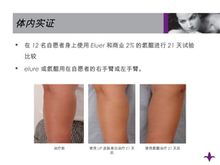 Elure clinical presentation - primary ta-cn | PPT