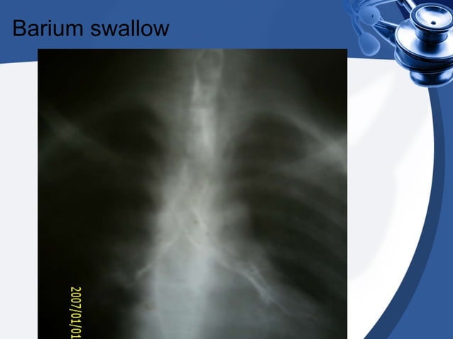 GBS case presentation | PPT | Physical Therapy | Wellness