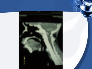 GBS case presentation | PPT