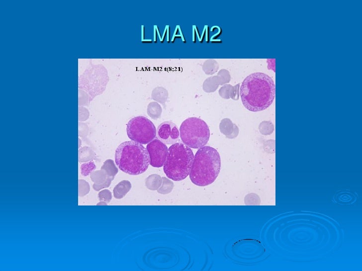 LEUCEMIAS AGUDAS.PDF