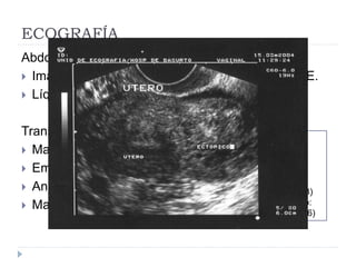 Embarazo ectopico | PPTX