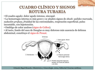 Embarazo ectopico1 | PPTX