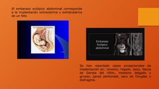 TECNICA QUIRURGICA DEL EMBARAZO ECTOPICO ABDOMINAL.pptx