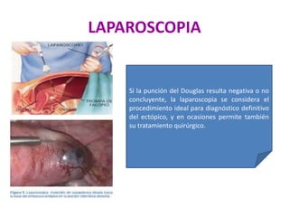 EMBARAZO ECTOPICO DESCRIPCION Y MANEJO.pptx