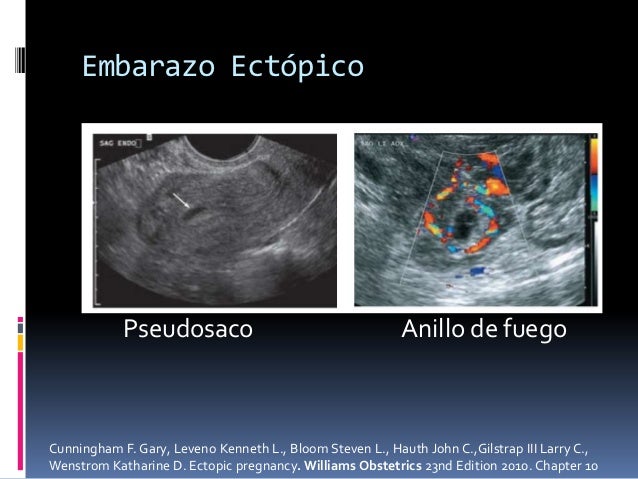 Embarazo Ectopico (2013)