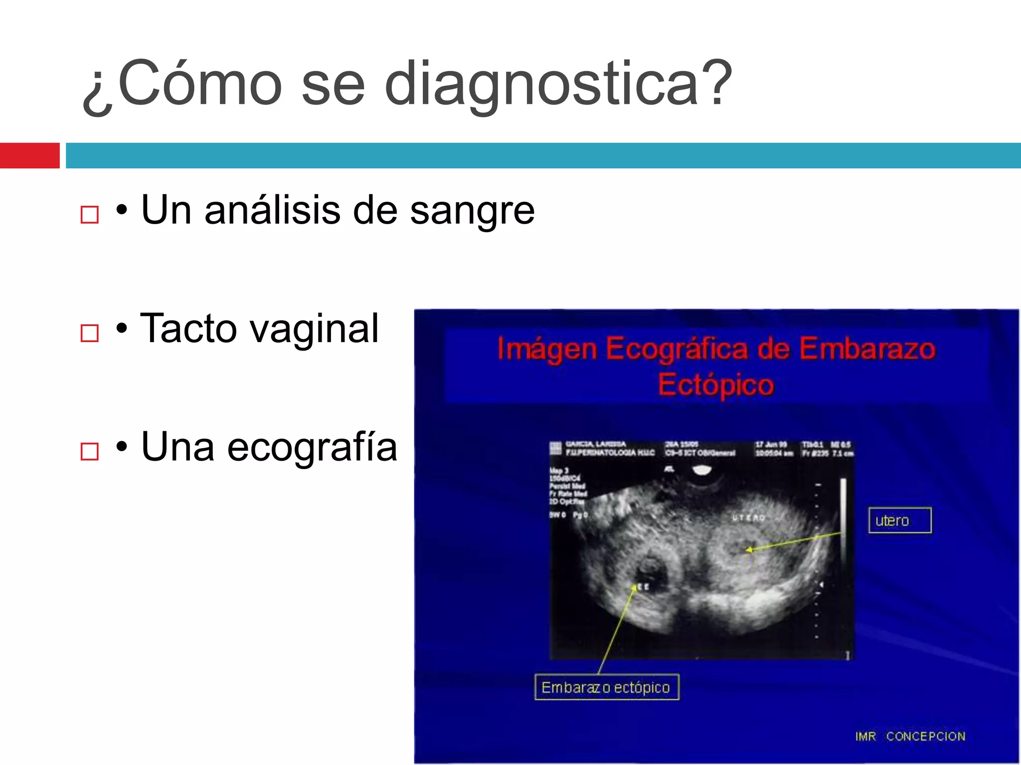 Embarazo Extrauterino o Ectópico | PPTX | Pregnancy | Reproductive Health