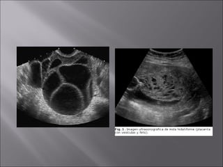 Embarazo molar | PPT