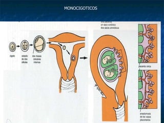Embarazos gemelares | PPT | Pregnancy | Reproductive Health