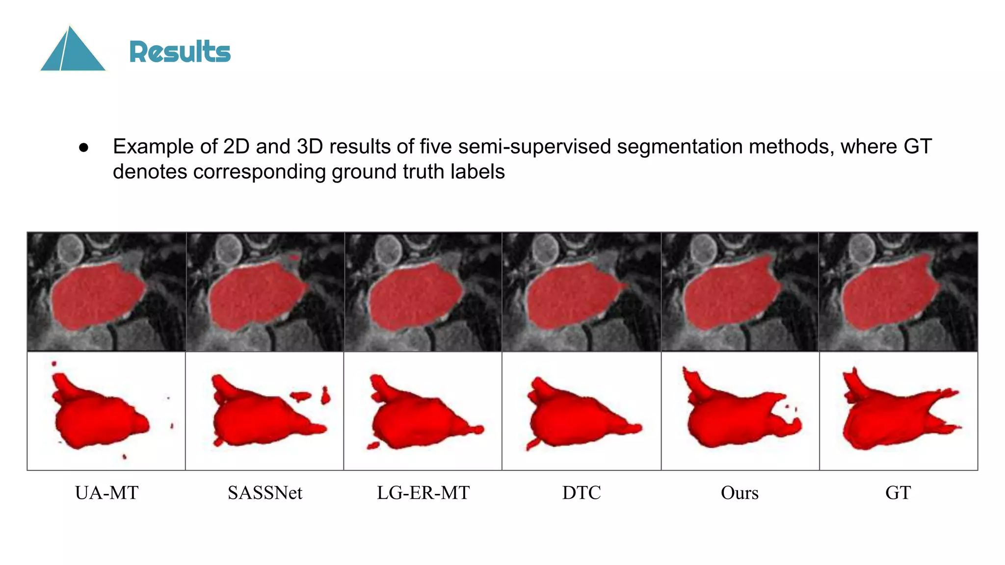[EMBC 2021] Hierarchical Consistency Regularized Mean Teacher for Semi-supervised 3D Left Atrium ...