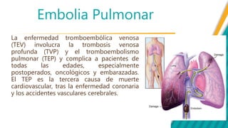 Embolia pulmonar | PPTX