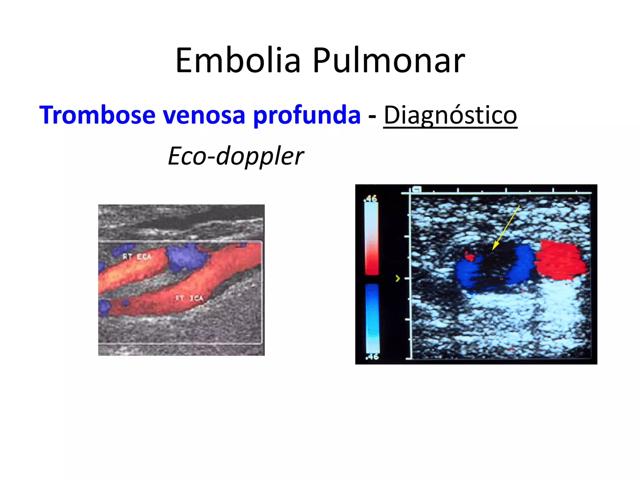Embolia Pulmonar Aula 11 | PDF