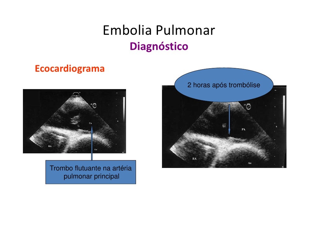 Embolia Pulmonar Aula 11