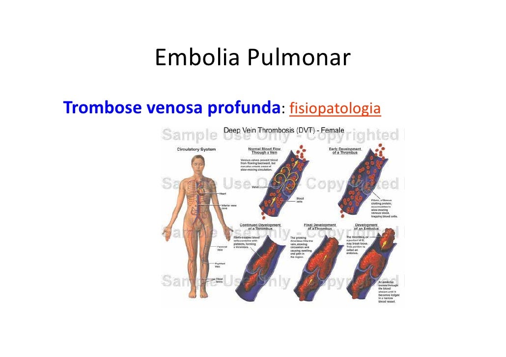 Embolia Pulmonar Aula 11