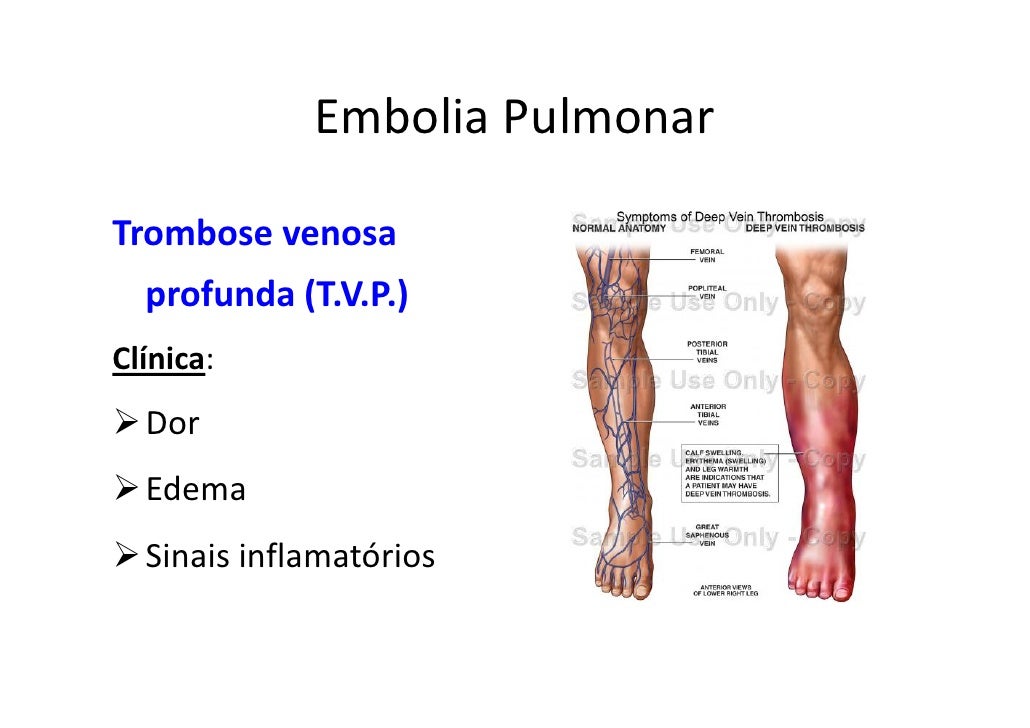 Embolia Pulmonar Aula 11