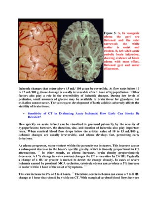Radiological pathology of embolic infarctions | PDF
