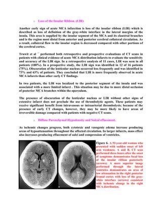 Radiological pathology of embolic infarctions | PDF