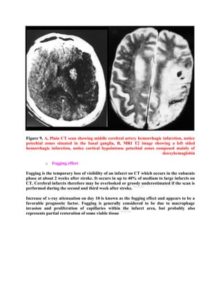 Radiological pathology of embolic infarctions | PDF