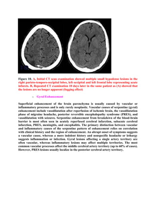 Radiological pathology of embolic infarctions | PDF