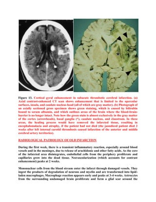 Radiological pathology of embolic infarctions | PDF