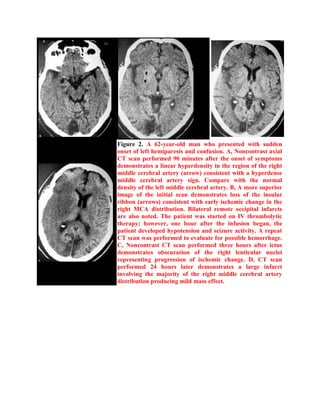 Radiological pathology of embolic infarctions | PDF