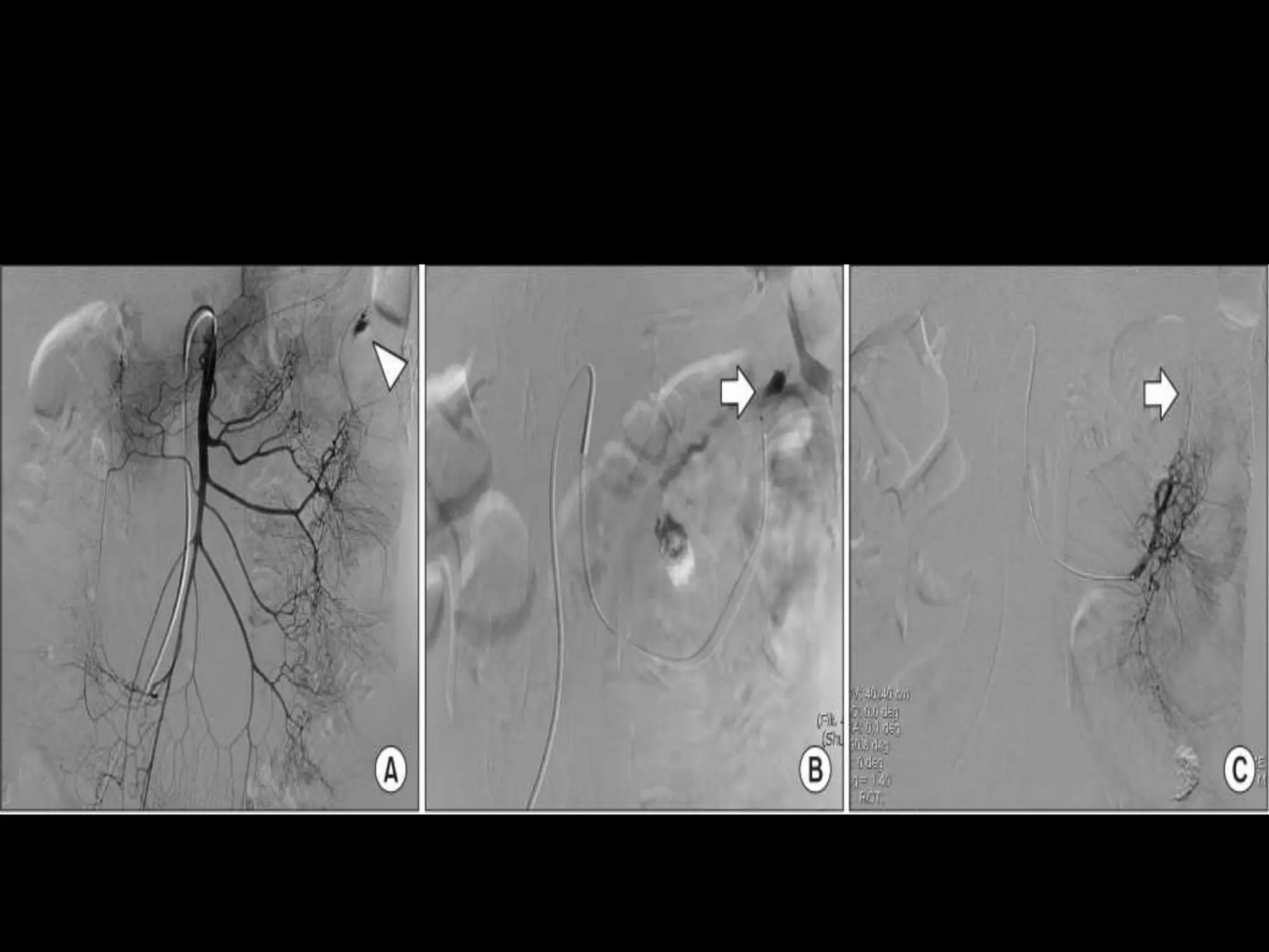 Embolic agents.pptx