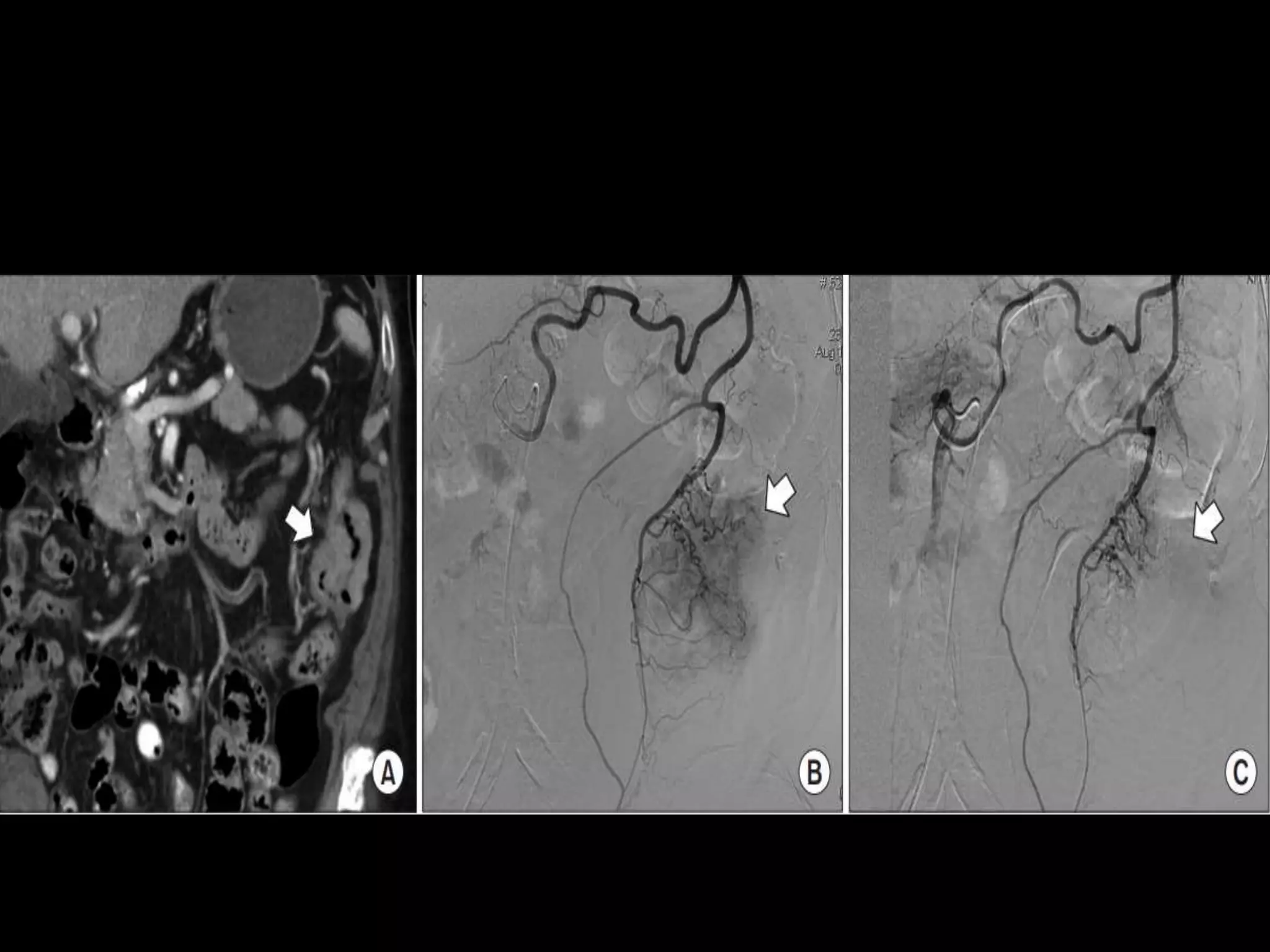 Embolic agents.pptx