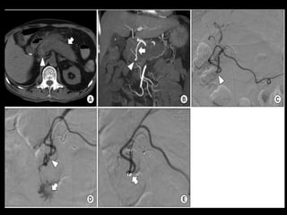 Embolic agents.pptx