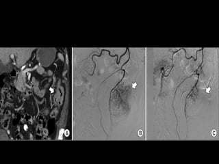 Embolic agents.pptx